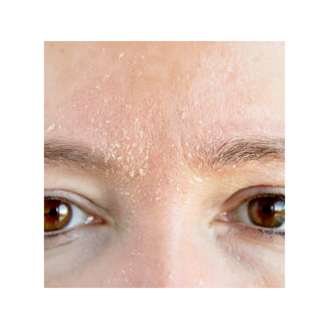 Dermatite seborréica - Dermatologista - Natal - RN - Instituto Regina ...